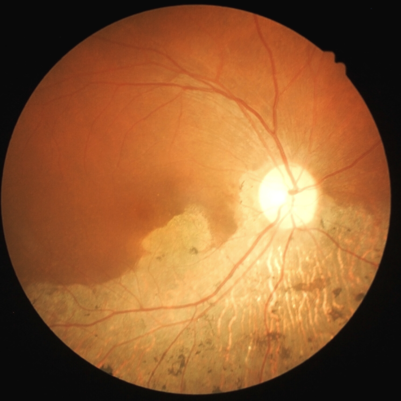 New & Innovative AMD Treatments - Fighting Blindness Canada (FBC)