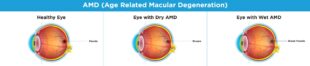 Age-Related Macular Degeneration - Fighting Blindness Canada (FBC)